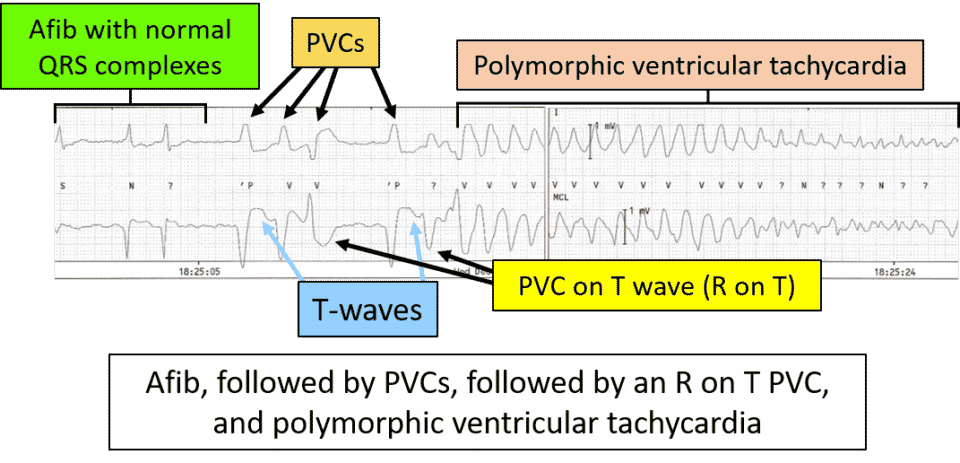 R on T Premature Ventricular Complexes (PVC) Simplified | ECGEDU.com