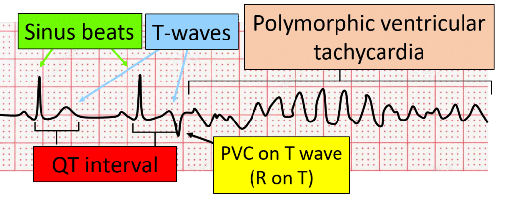 R on T Premature Ventricular Complexes (PVC) Simplified | ECGEDU.com