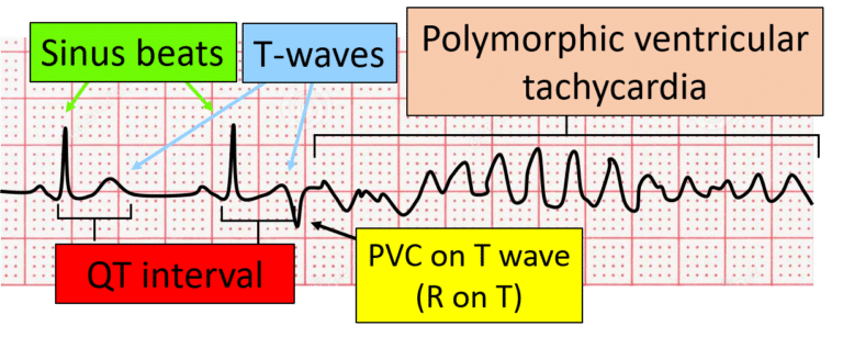 R on T Premature Ventricular Complexes (PVC) Simplified | ECGEDU.com