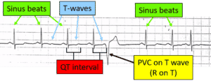 R on T Premature Ventricular Complexes (PVC) Simplified | ECGEDU.com