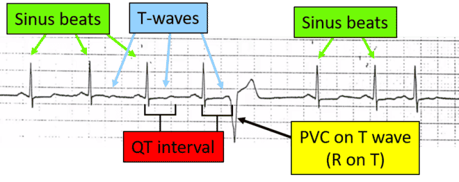 R on T Premature Ventricular Complexes (PVC) Simplified | ECGEDU.com